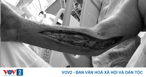 Viêm mô tế bào nặng, bệnh nhân cắt bỏ 2/3 chi để bảo toàn tính mạng ...