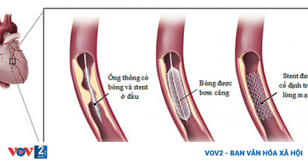 Đặt sten ngược dòng: Giải pháp tối ưu điều trị thiếu máu cơ tim